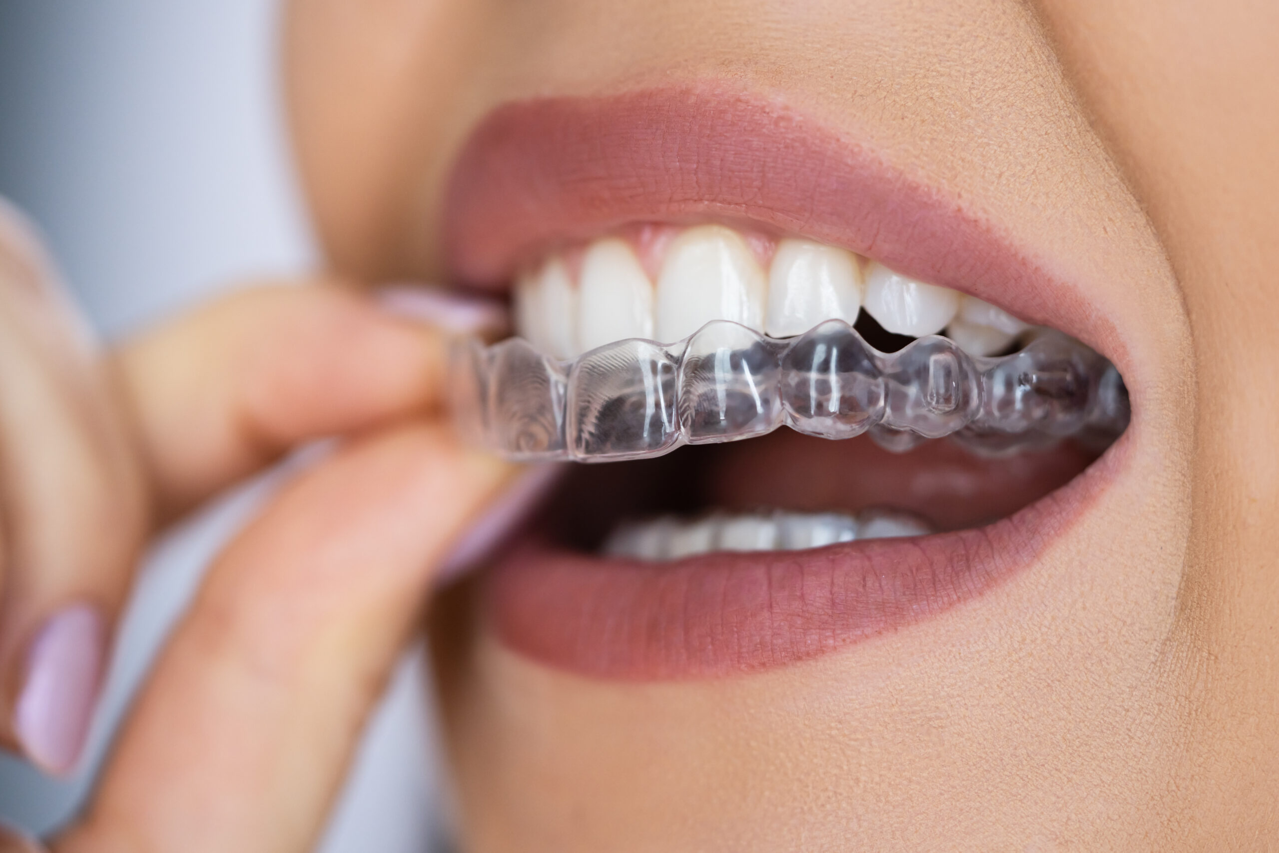 How Long Should You Wear Invisalign? | Spark Dental SD